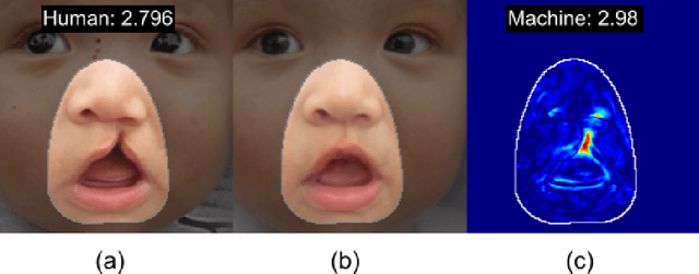 Unsupervised Anomaly Appraisal of Cleft Faces Using a StyleGAN2-based ...