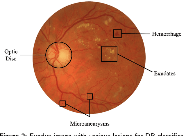 Diabetic Retinopathy Detection: Models, code, and papers - CatalyzeX